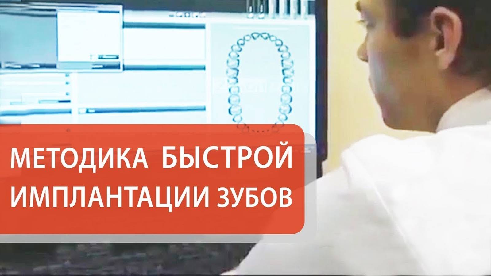 Имплантация с немедленной нагрузкой. 👏 Новейшие возможности имплантации с немедленной нагрузкой.12+