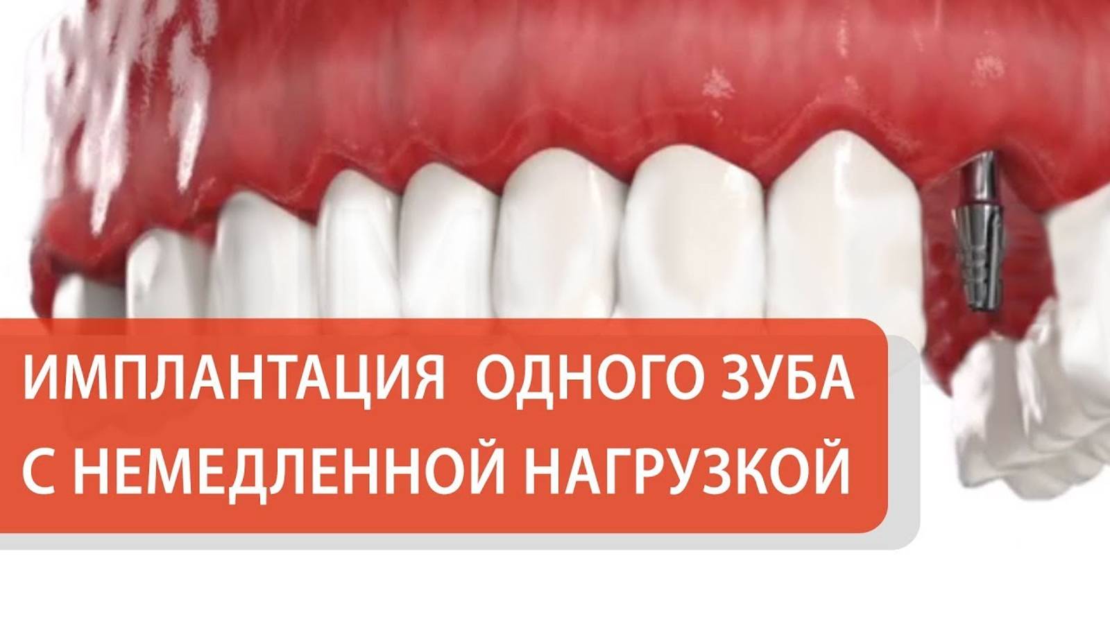 Восстановление целостности зубного ряда путем установки одного импланта в эстетической зоне (12+).