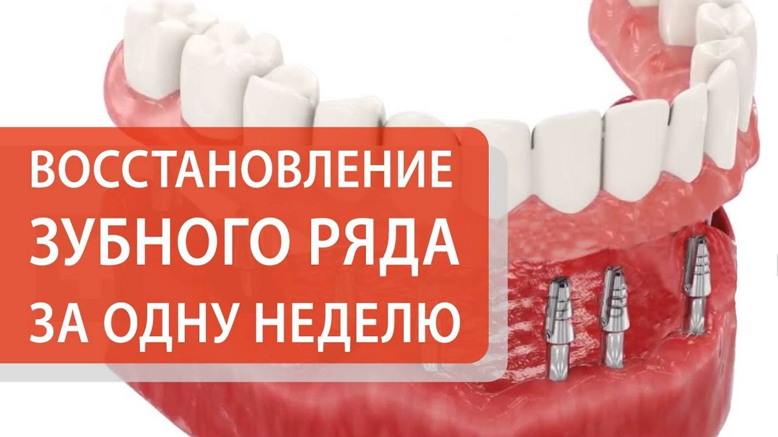 Посмотрите наглядно: как можно восстановить зубной ряд с помощью имплантов. Симпладент 12+