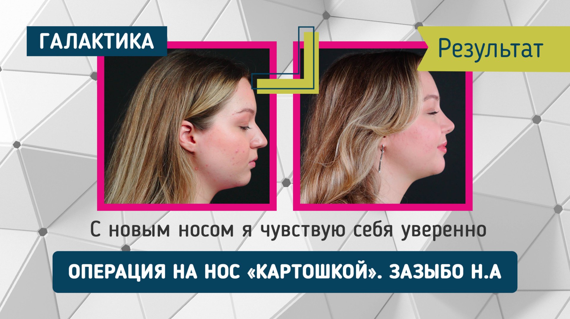 Операция на нос "картошкой" | Зазыбо Николай Александрович