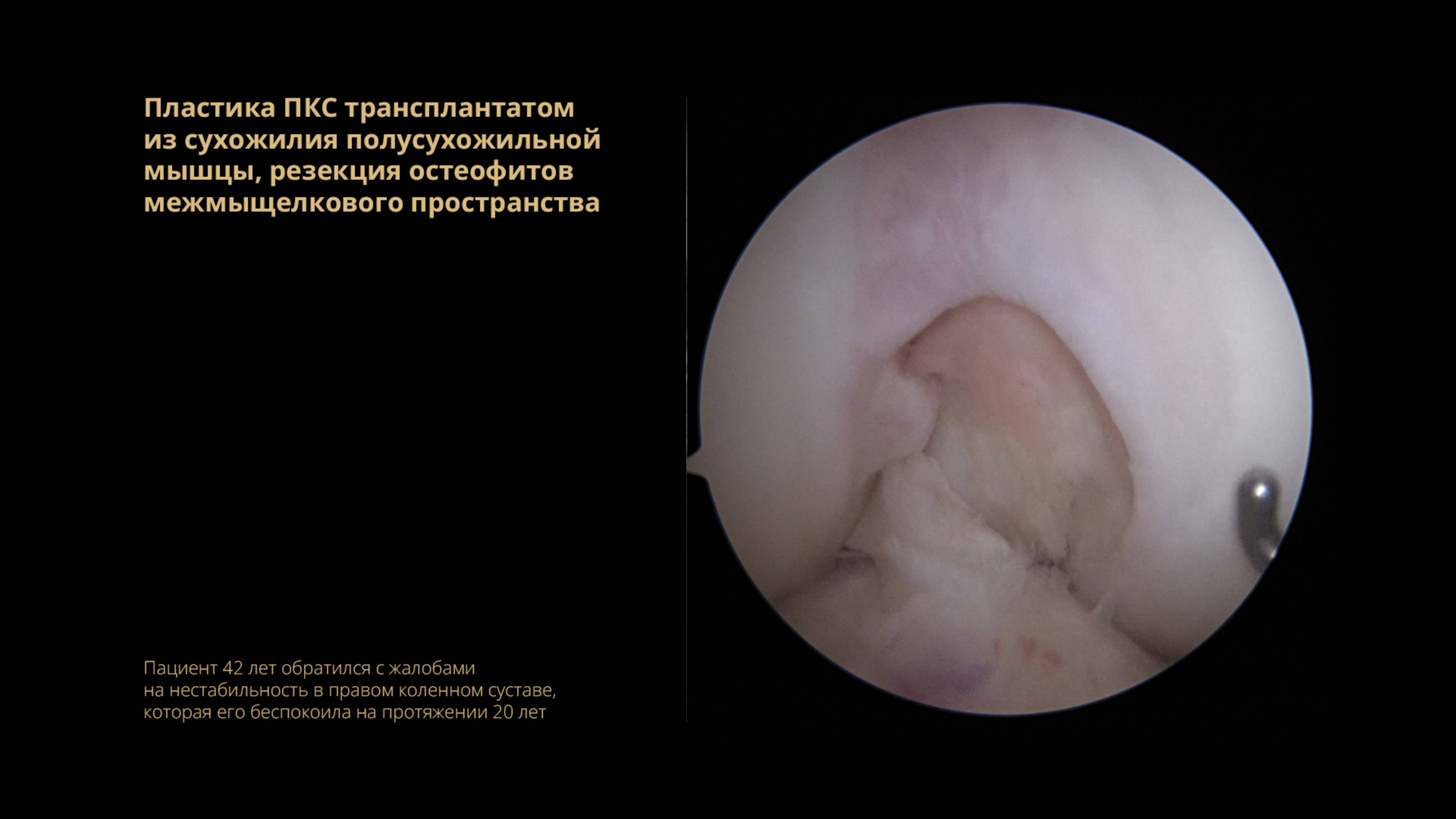 Пластика ПКС трансплантатом из сухожилия полусухожильной мышцы, резекция остеофитов межмыщелкового