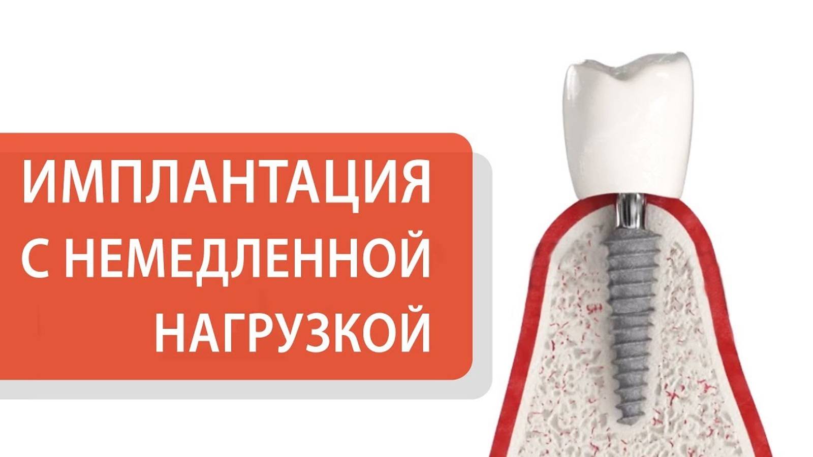Имплантация зубов с немедленной нагрузкой. Пример операции. Этапы установки импланта. Симпладент