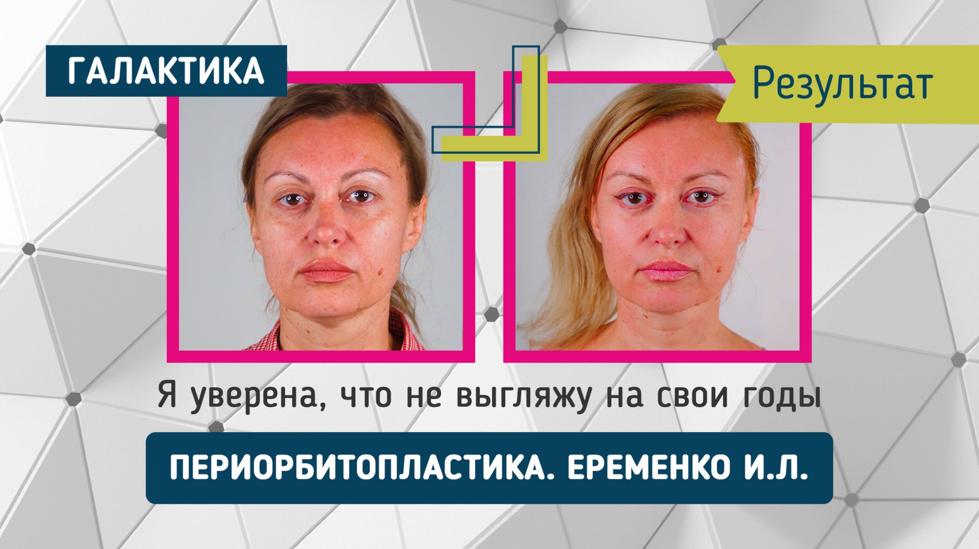 Проект "Оморфия" результат периорбитопластики | Еременко Ирина Леонидовна