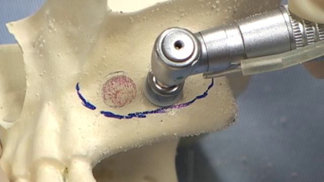 Открытый синус-лифтинг с набором LAS KIT. Практика на учебной модели