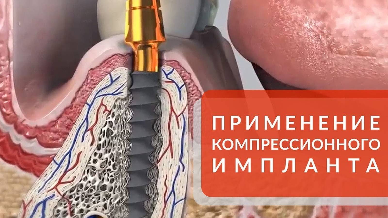 Наглядный пример проведения имплантации зубов: как проводится операция. Симпладент. 12+