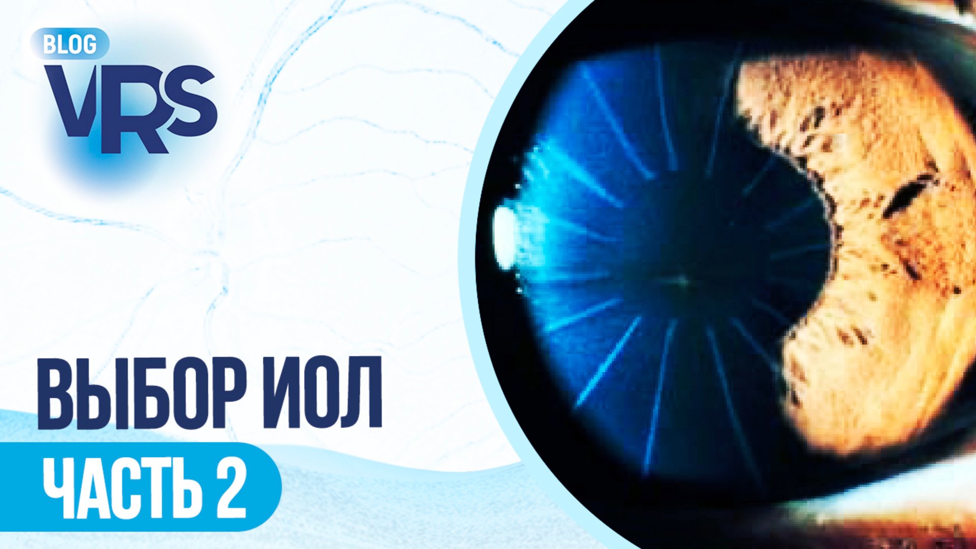 Расчёт ИОЛ после радиальной кератотомии