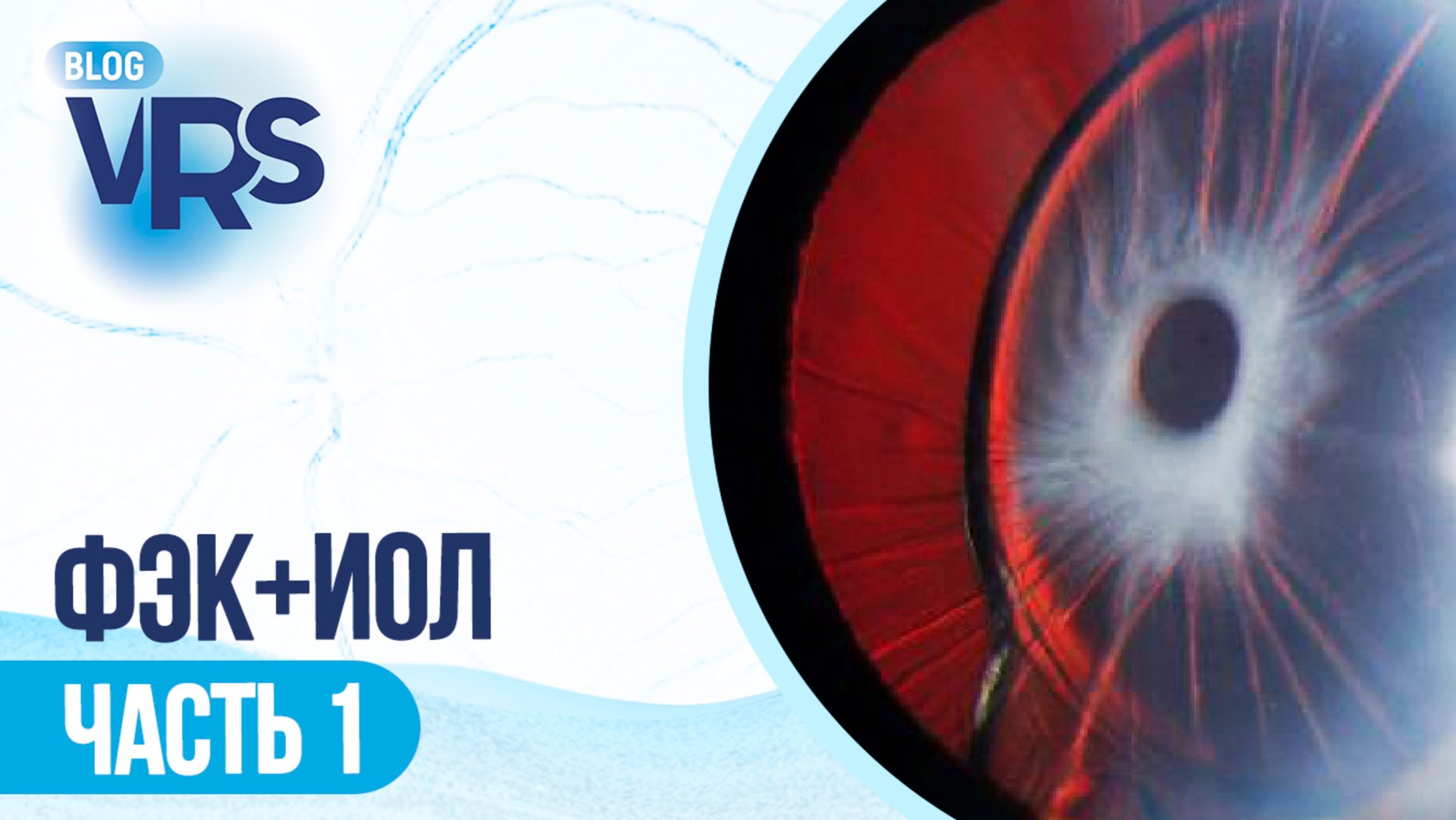 Хирургия катаракты