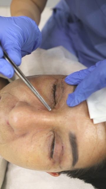 Снятие швов и стрипов после круговой блефаропластики.