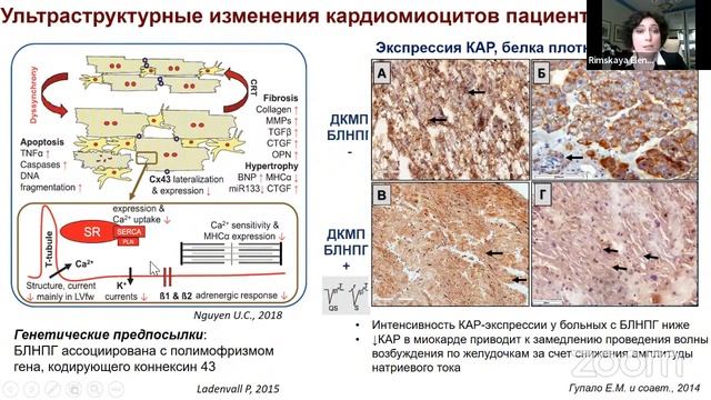 Блокада левой ножки пучка Гиса – причина или следствие кардиомиопатии
