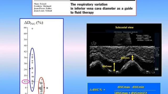 Predicting fluid responsiveness Teboul Jean Louis 2018