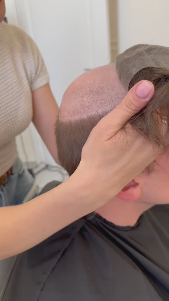 Какая мужская система волос (накладка) при облысении лучше?