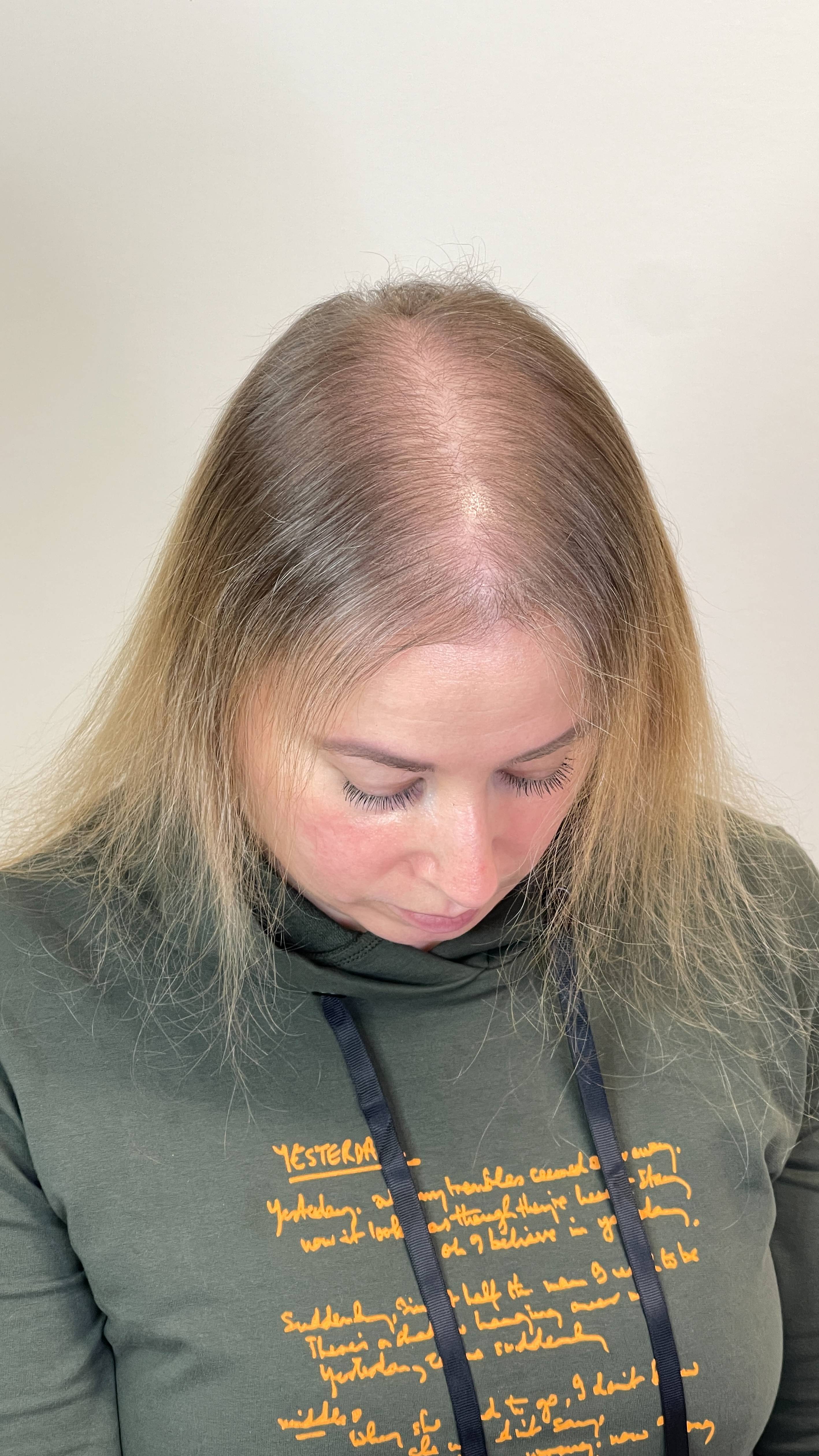 Реальная трансформация: как система меняет всё! #алопеция #системаволос #преображение