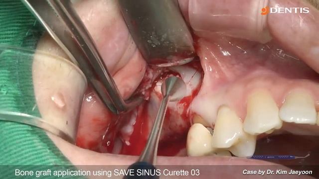 Операция по открытому синус-лифтингу