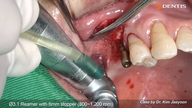 Закрытый синус-лифтинг