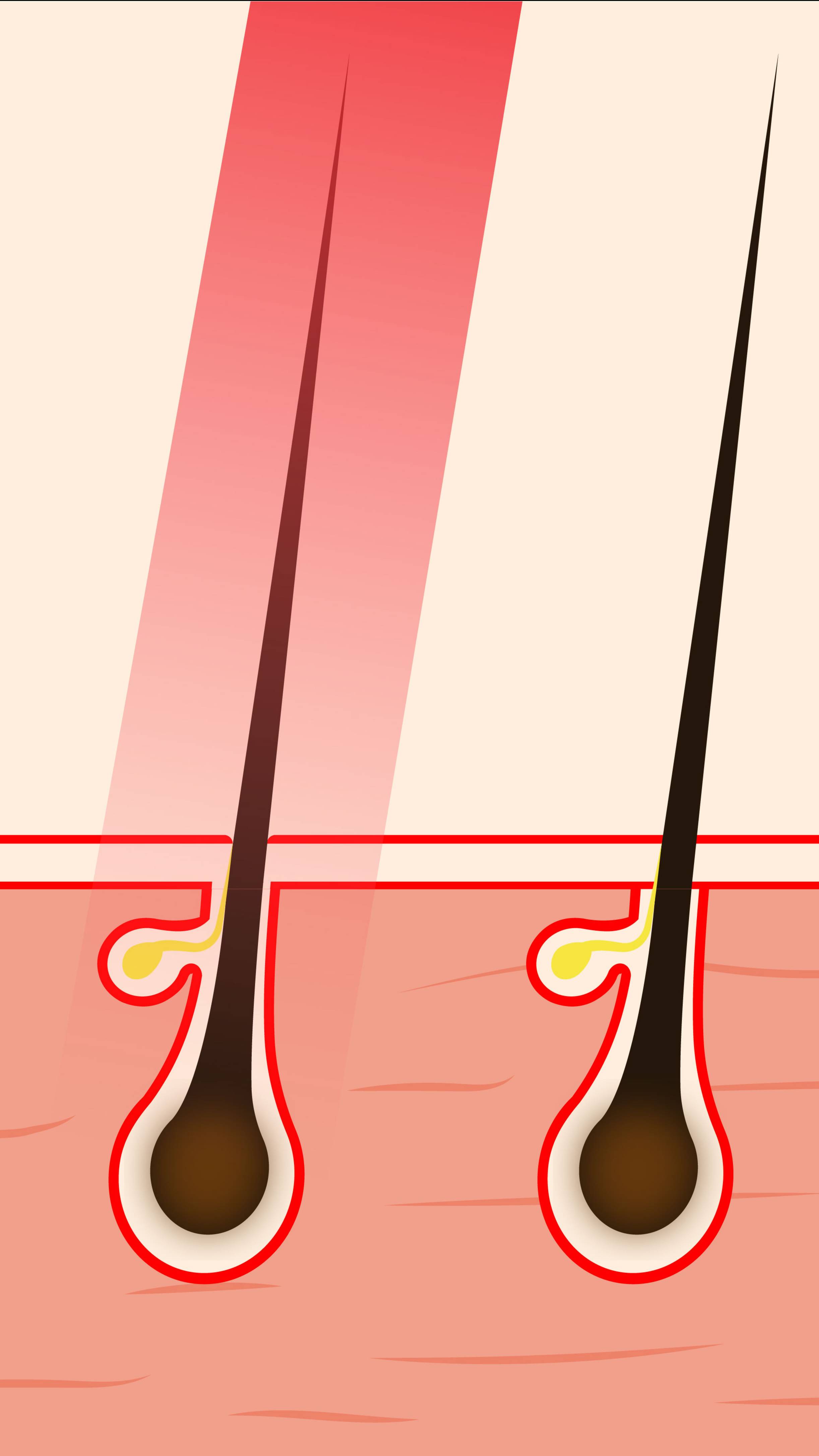 Диодная эпиляция в Институте на Трубной