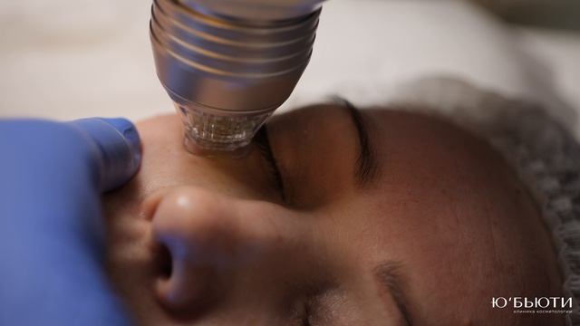 Микроигольчатый RF-лифтинг на аппарате Инус