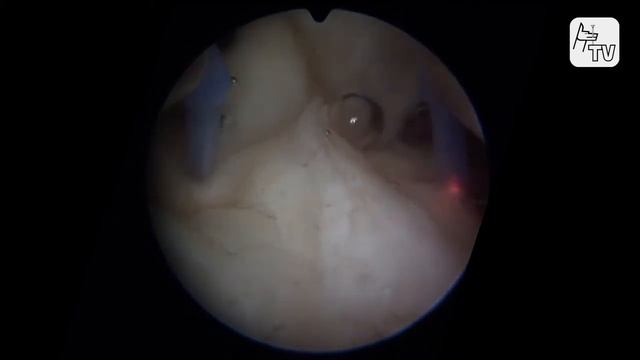 Endovideo RESECTION MASTER-02