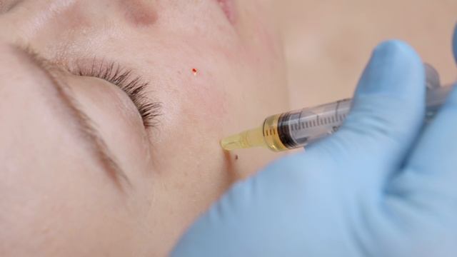 Процедура плазматерапия + фотоомоложение на аппарате Нордлис Кандела ( Nordlys Candela)