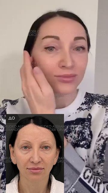 2 месяца после Deep Plane Facelift