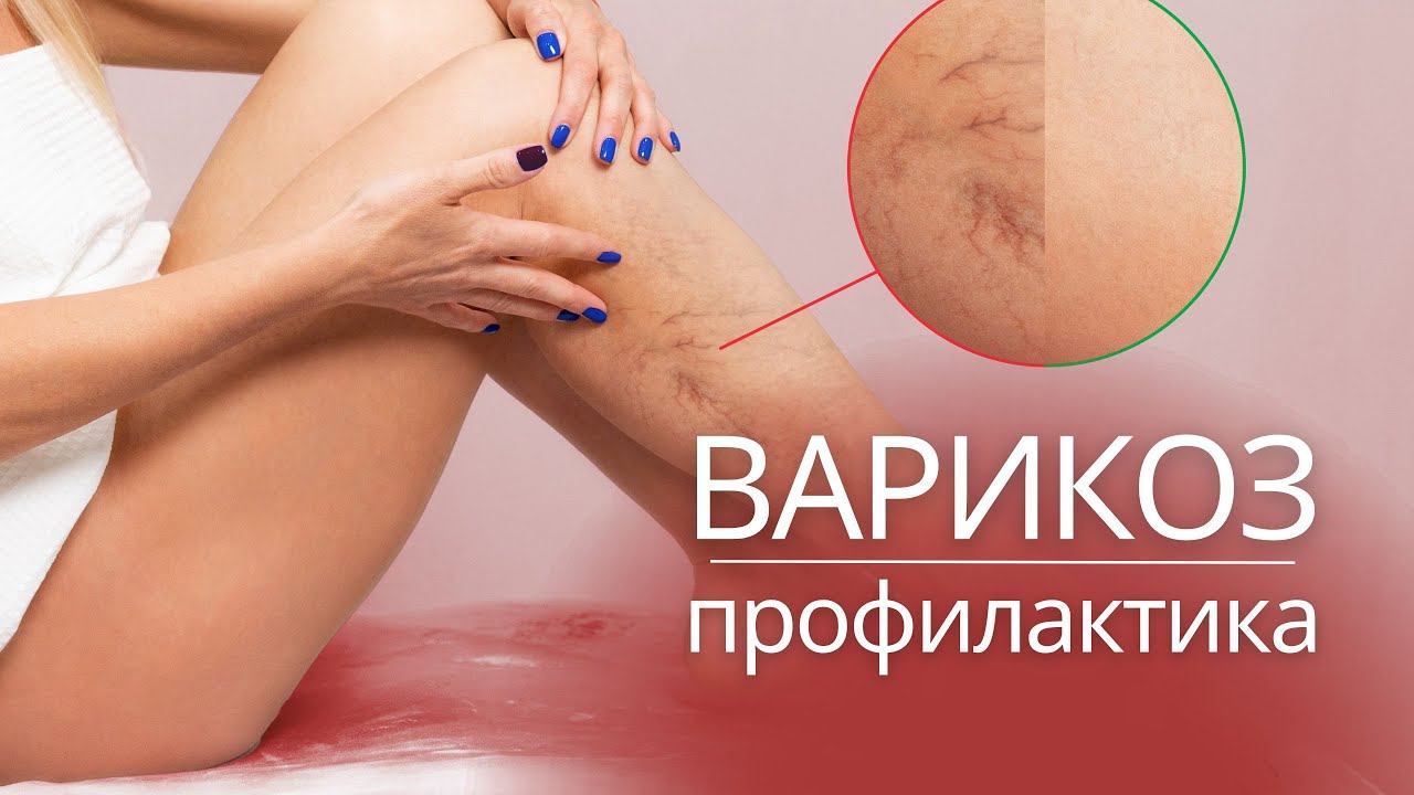 МАССАЖ при ВАРИКОЗЕ | Профилактика