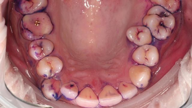 Правильная гигиена зубов — ключ к здоровым деснам!