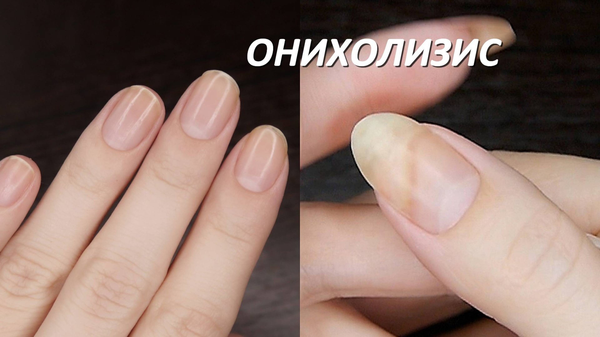 Онихолизис мой опыт, травматический онихолизис