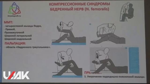 компрессионные синдромы 5