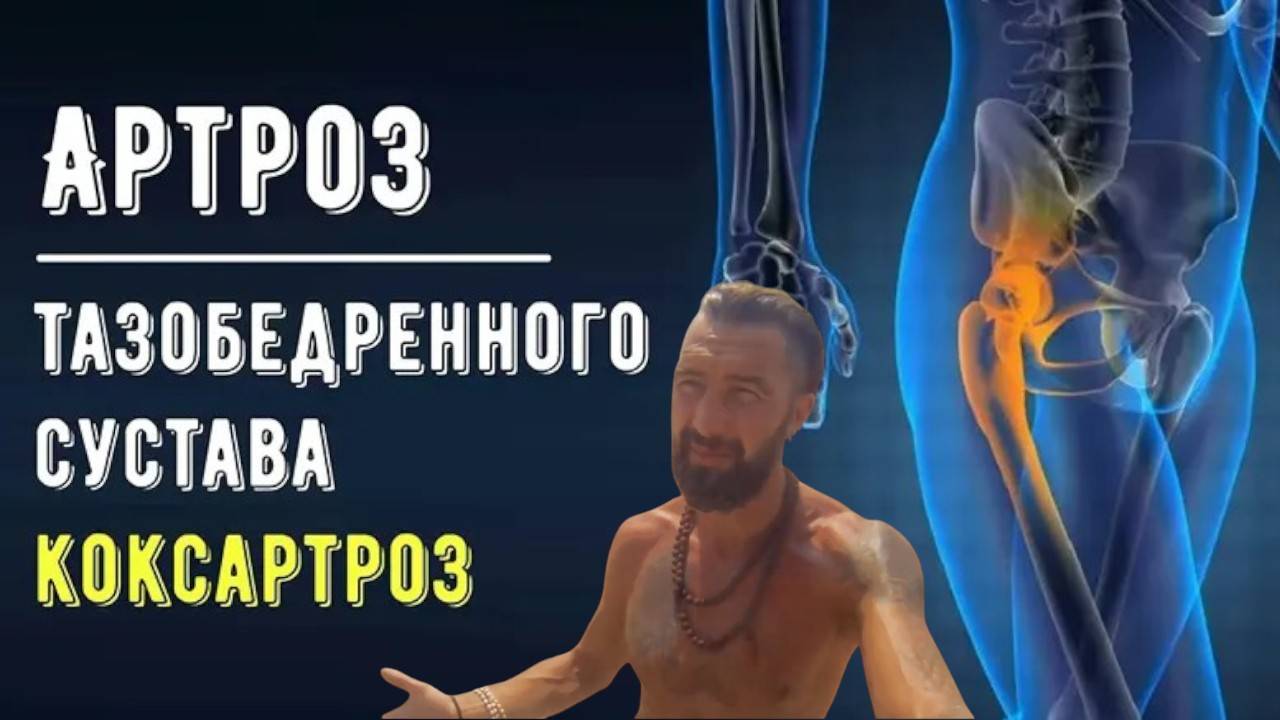 Профилактика тазобедренный артроз поясница