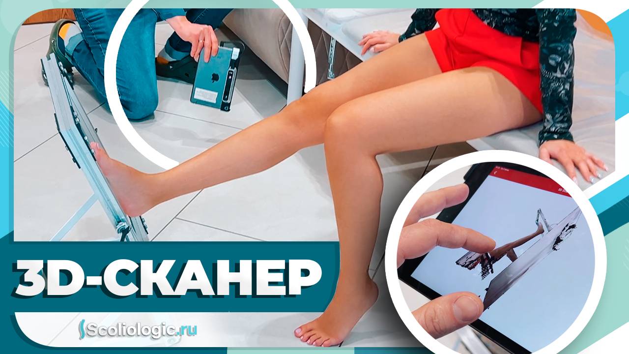 Современная замена гипсовым слепкам при изготовлении ортезов