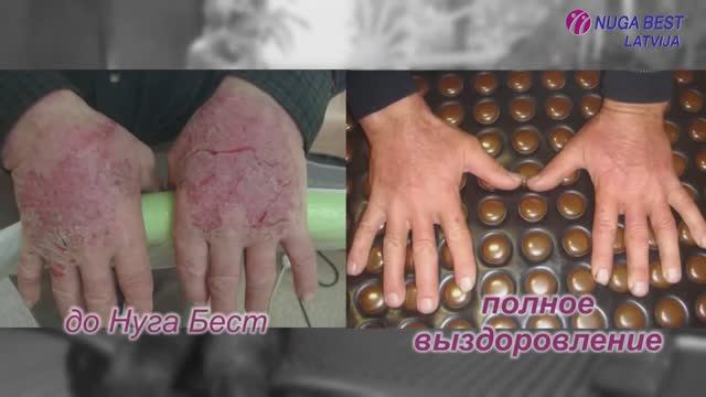 Вячеслав избавился от экземы на коже