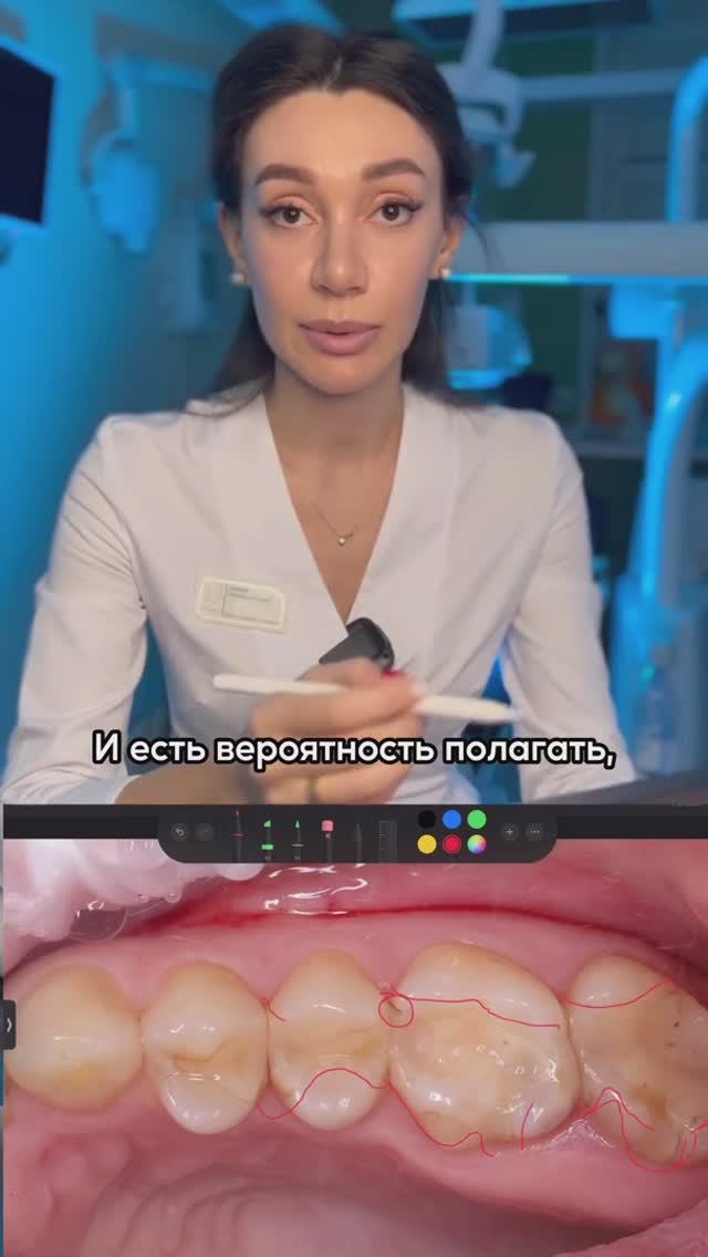 ⚕️ Кариес под пломбами! Клинический случай Belgravia Dental Studio