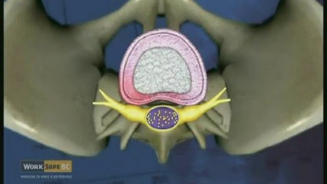 Образование грыжи