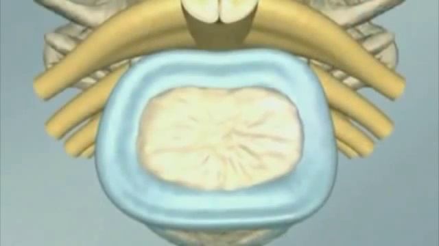 Формирование межпозвонковой грыжи