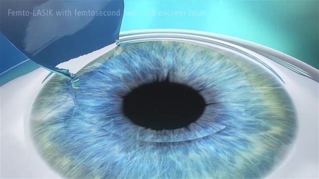 Лазерная коррекция зрения Femto Lasik
