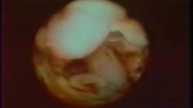 Холестерин в крови, органах