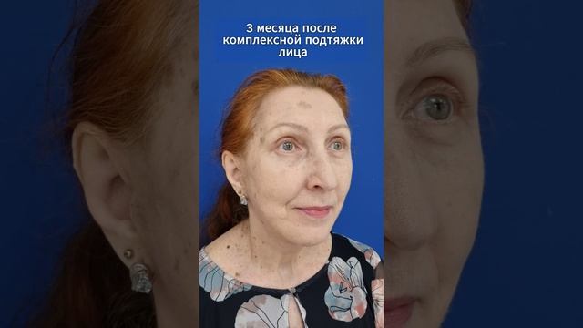Комплексное омоложение: после подтяжки лица.