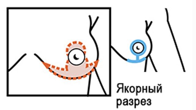 Методы подтяжки груди