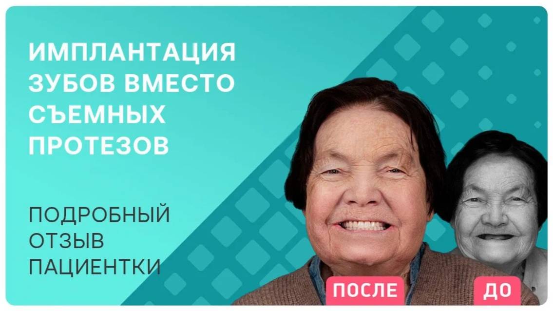 Стоит ли решаться на имплантацию зубов в 70+ лет? Делюсь личным опытом