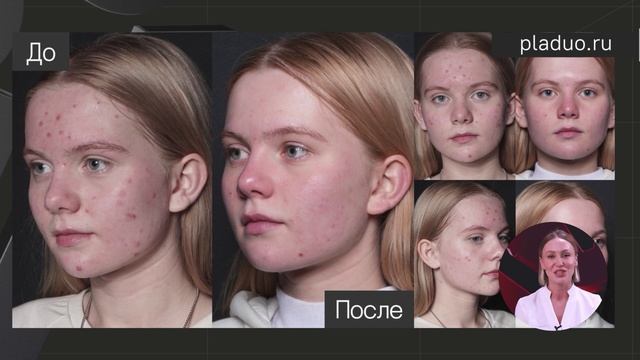 Разбор кейсов. Терапия акне на аппарате PLADUO. Инновационный метод — холодная плазмотерапия.