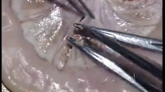 Mesenteric_Vessel_Ligation