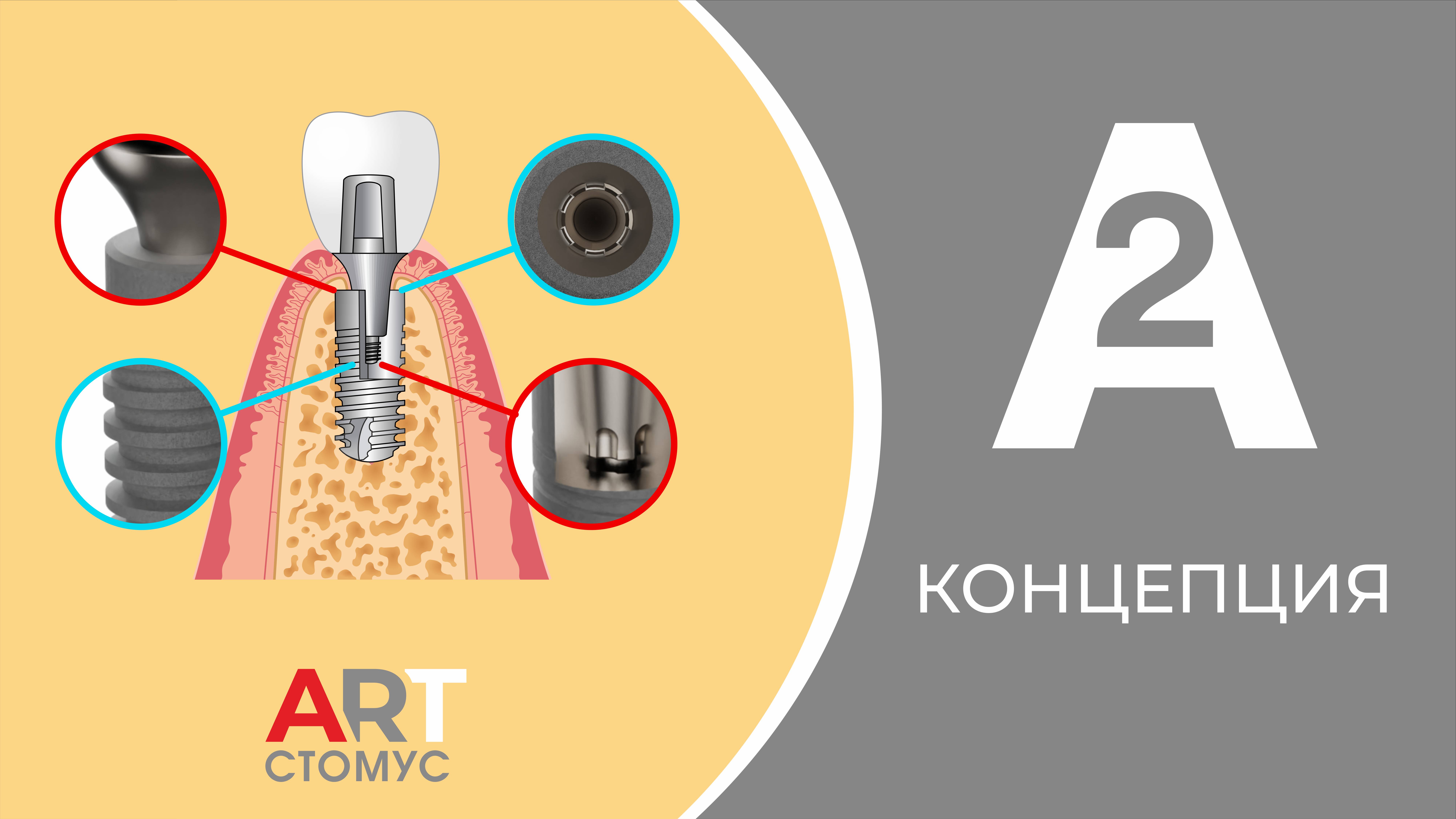 КОНЦЕПЦИЯ ИМПЛАНТАЦИОННОЙ СИСТЕМЫ А2