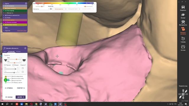 Моделирование индивидуальных титановых абатментов и анатомии под них