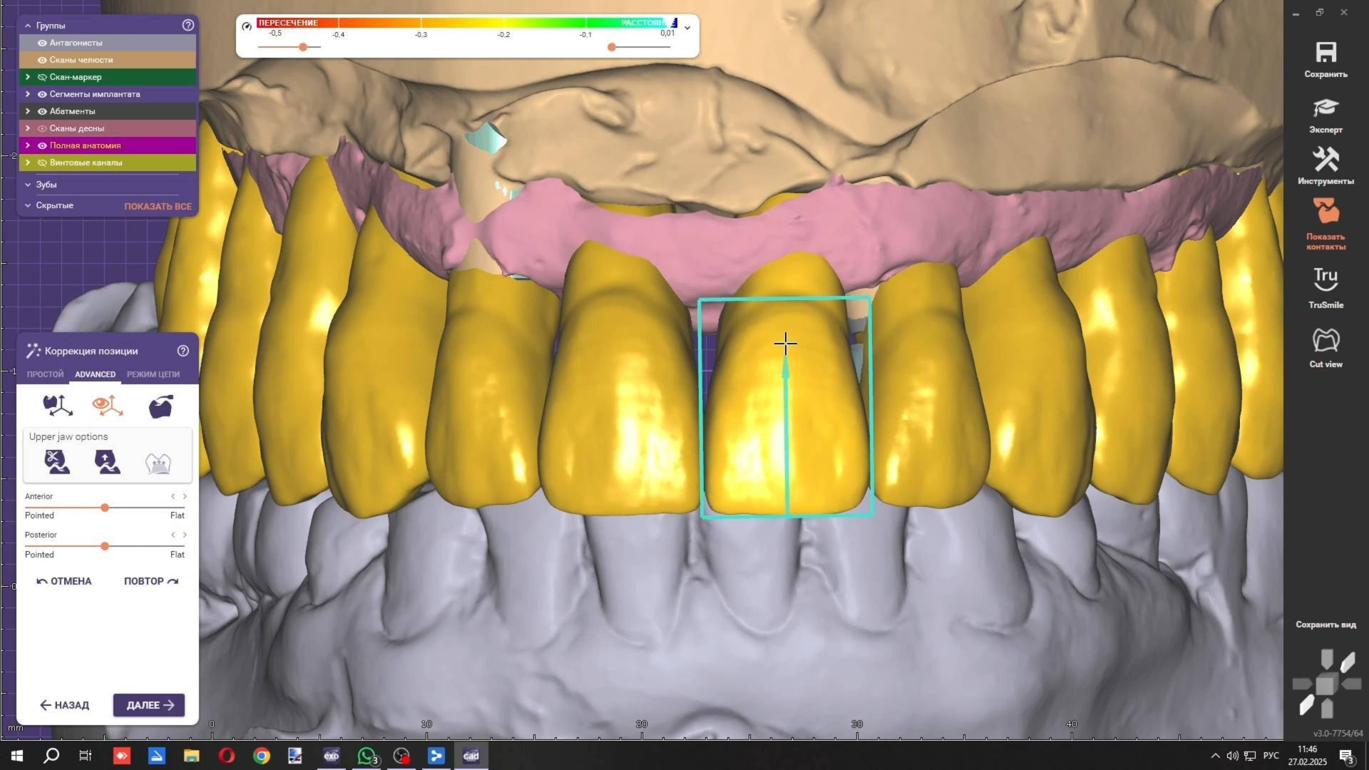 Сканирование и моделирование прототипа с искусственной десной