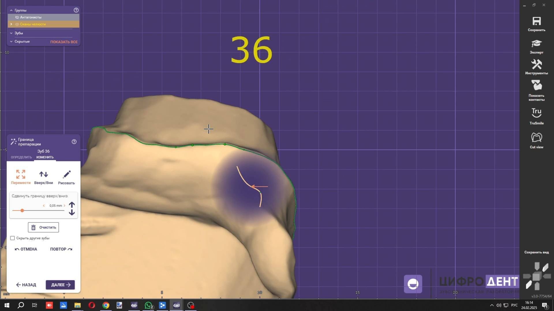 Моделирование полноанатомической коронки из диоксида циркония на культе
