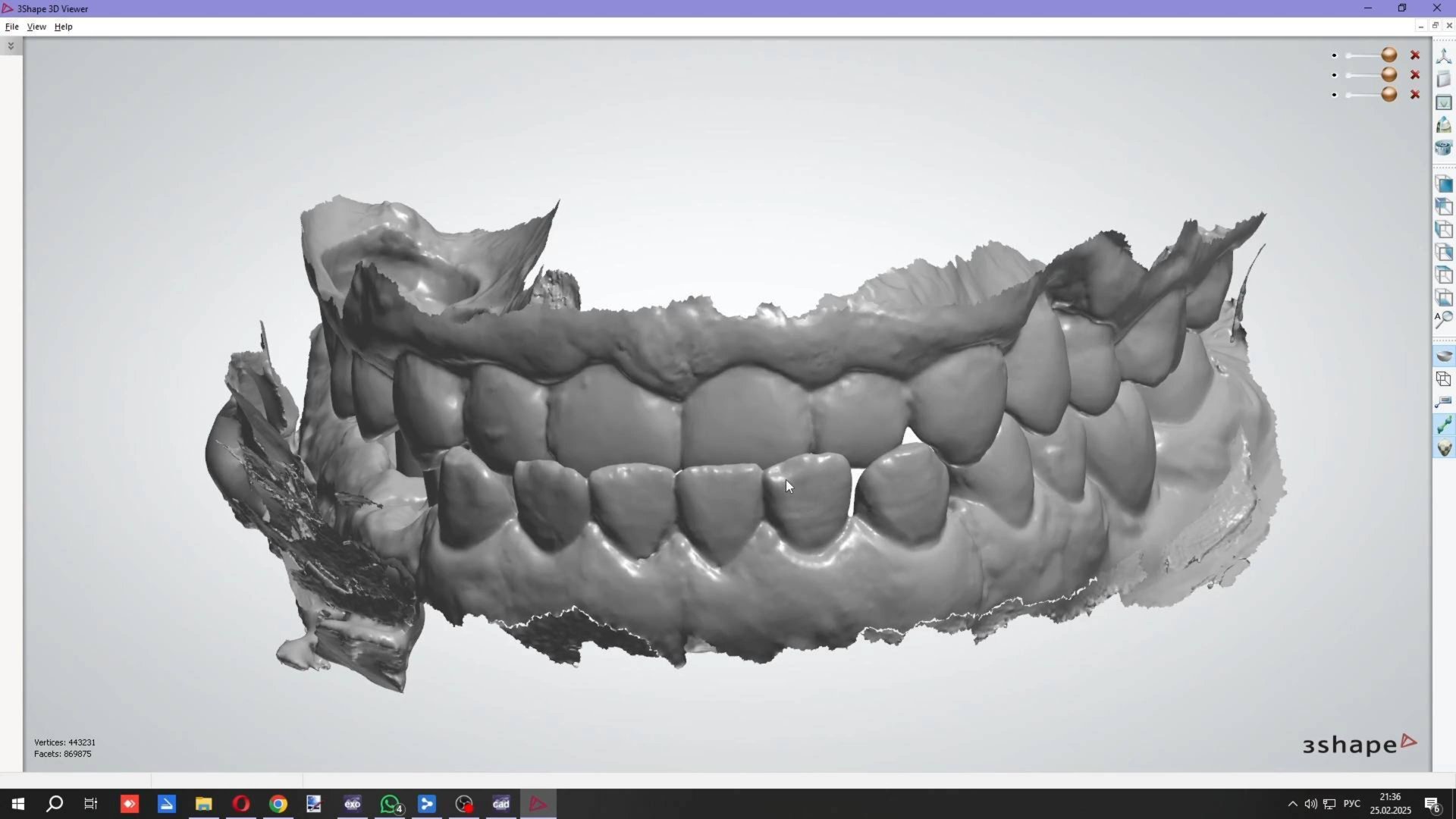 Подгрузка интраоральных сканов, мостовидный протез РММА винтовой фиксации
