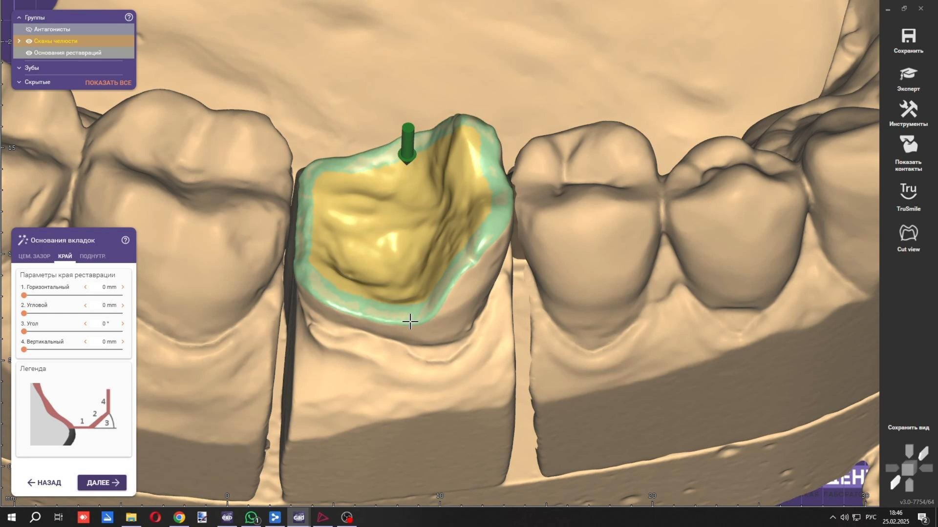 Сканирование и моделирование культевой вкладки из воска