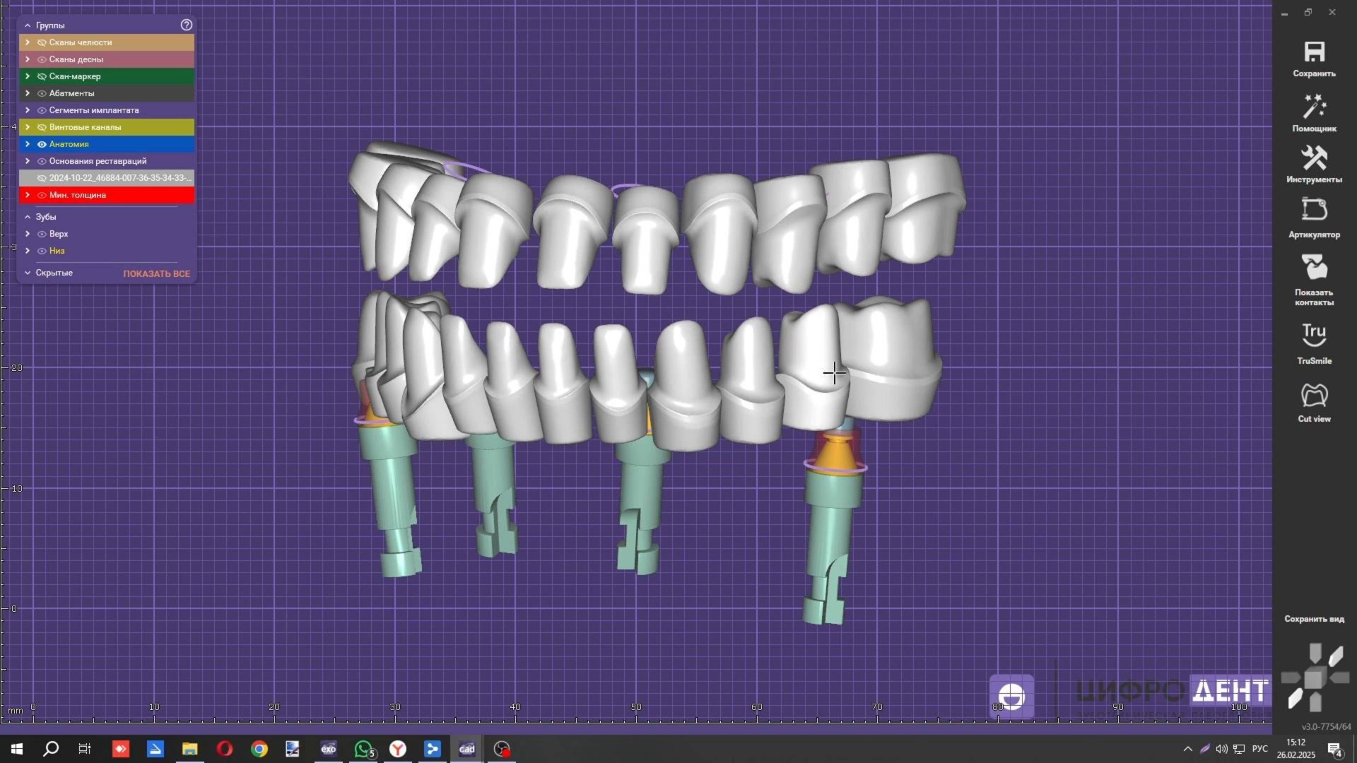 Тотальная работа с искусственной десной, каркас под нанесение