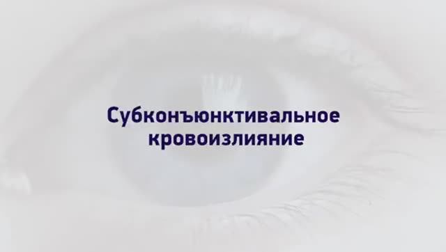Кровоизлияние в глаз - как лечить, что делать с субконъюнктивальным кровоизлияни