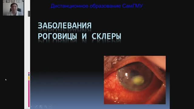 Заболевания роговицы и склеры(1)