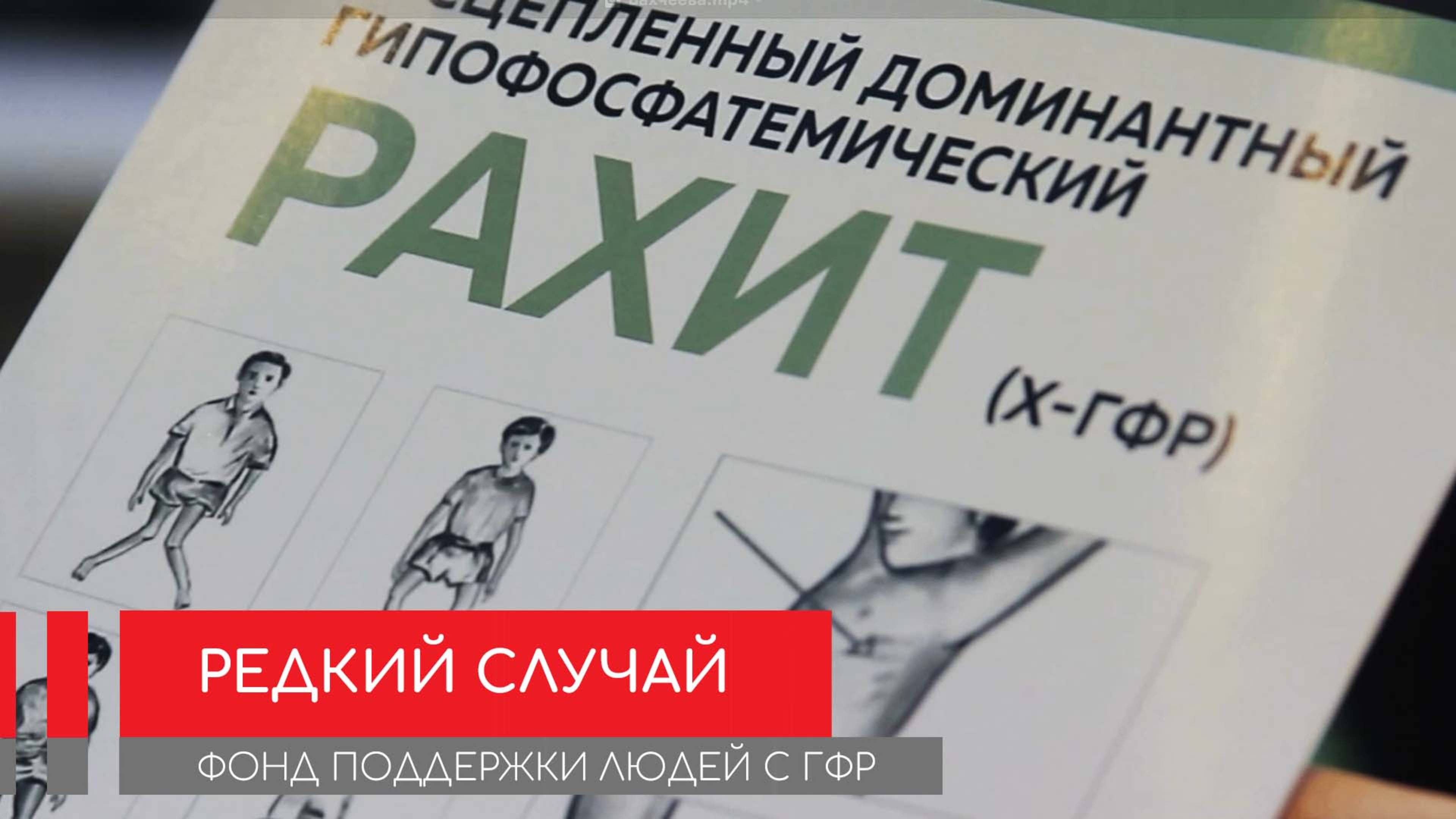 Москвичей спросили о редком заболевании - ГФР